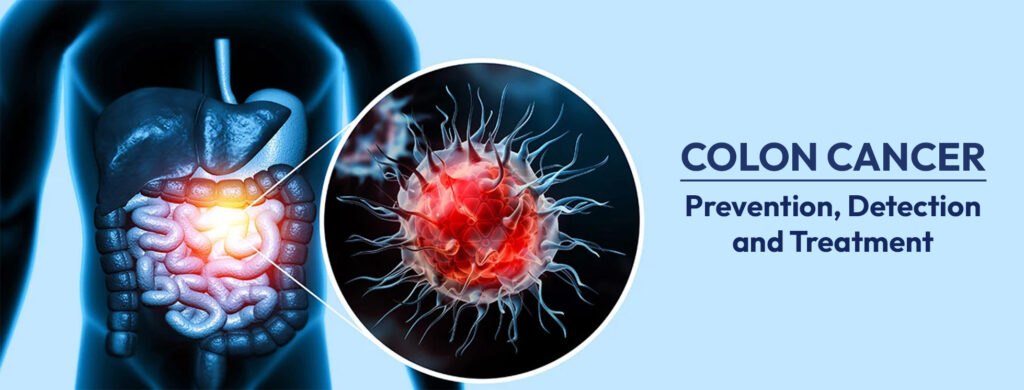 Colon Cancer: Prevention, Detection & Treatment in Bangalore